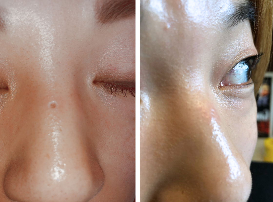 Subcision for Scar & Acne Treatment | Dermatologist Dr. Penelope ...