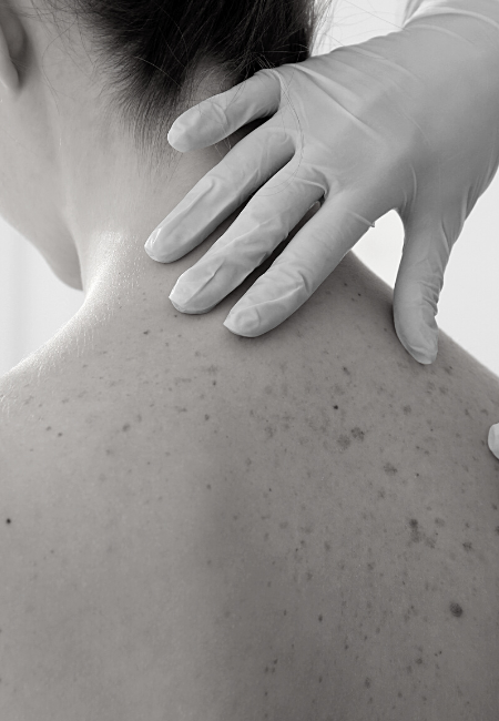 Treatments - Dermaperfect